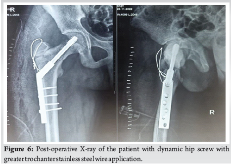 Transtrochanteric Transverse Fracture of Proximal Femur in Pediatric ...