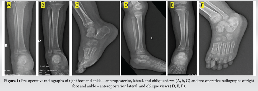 An Uncommon Case of Bilateral Ankle and Foot Injury in a Pediatric ...
