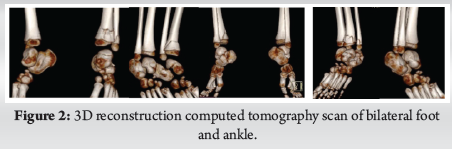 An Uncommon Case of Bilateral Ankle and Foot Injury in a Pediatric ...