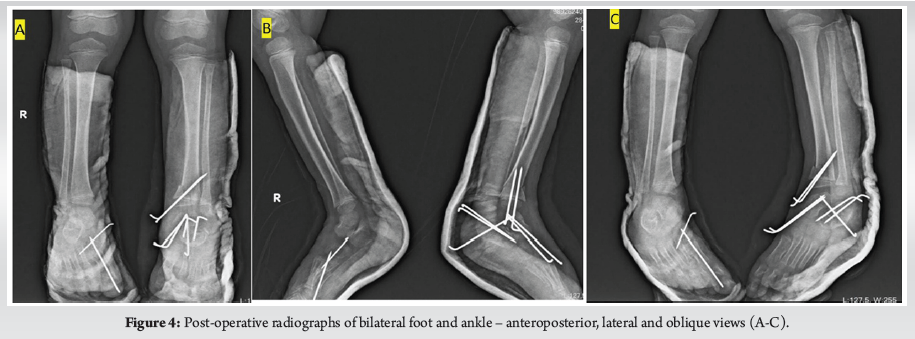 An Uncommon Case of Bilateral Ankle and Foot Injury in a Pediatric ...