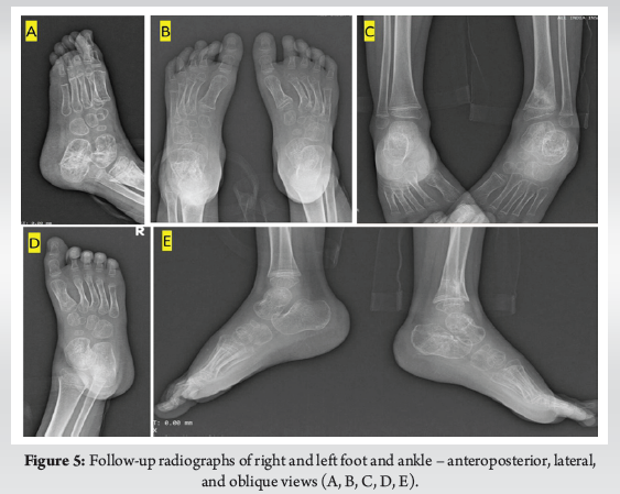 An Uncommon Case of Bilateral Ankle and Foot Injury in a Pediatric ...