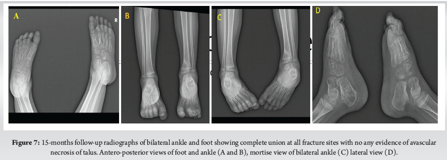An Uncommon Case of Bilateral Ankle and Foot Injury in a Pediatric ...