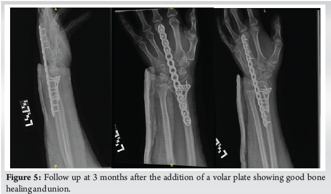 Fixation of 3-Part Intra Articular Distal Radius Fracture with Combined ...