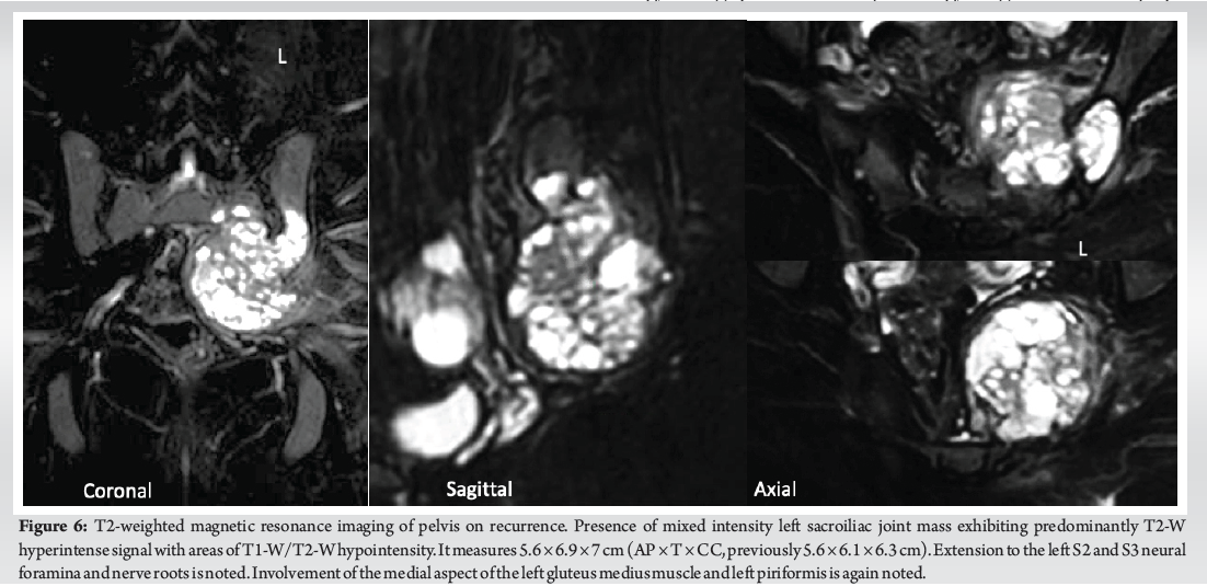 Percutaneous Doxycycline Ablation for Recurrent Aneurysmal Bone Cyst in ...