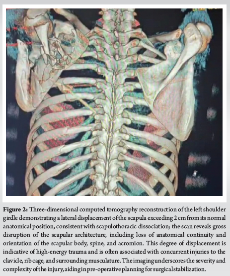 Complex Scapulothoracic Disruption Managed with Scapular Dual Column ...