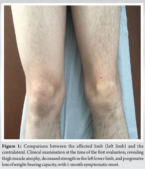 Femoral Neuropathy Secondary to a Spontaneous Iliac Hematoma | Journal ...