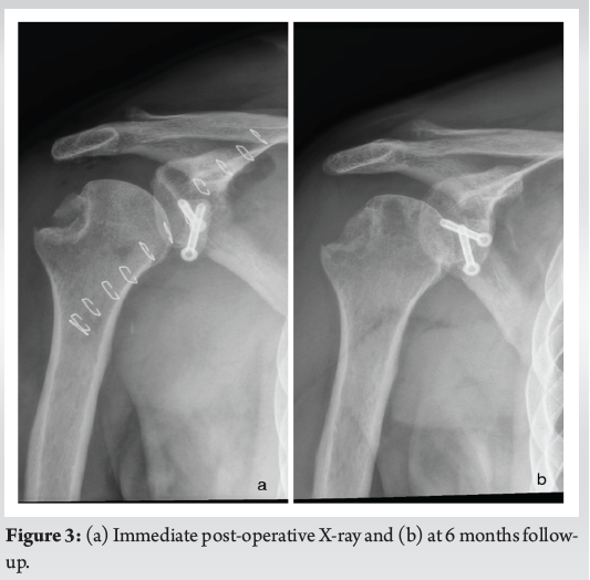 Locked Neglected Anterior Shoulder Dislocation Treated With Open ...