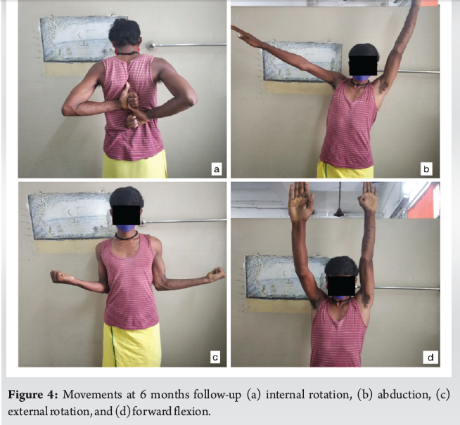 Locked Neglected Anterior Shoulder Dislocation Treated With Open ...