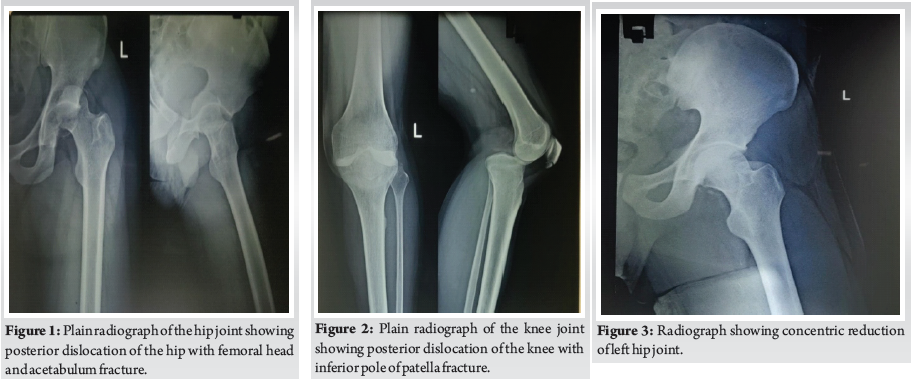 Can a Traumatic Pipkin Fracture – Dislocation and Ipsilateral Knee ...