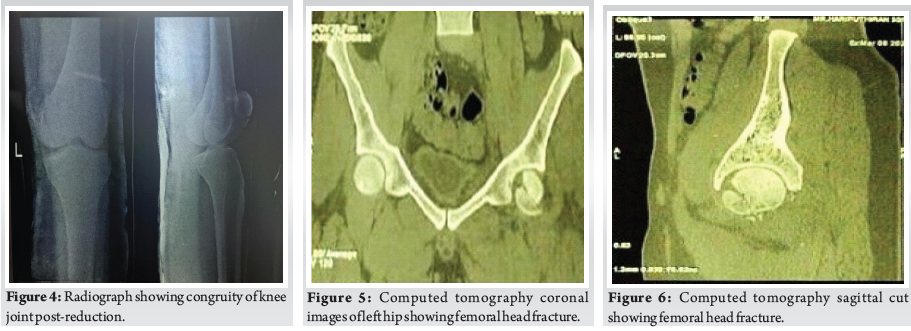 Can a Traumatic Pipkin Fracture – Dislocation and Ipsilateral Knee ...