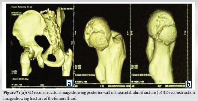 Can a Traumatic Pipkin Fracture – Dislocation and Ipsilateral Knee ...