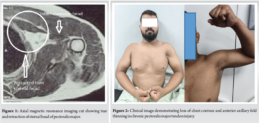 A Wrestler’s Nightmare: Pectoralis Major Tendon Tear and its Repair-A ...