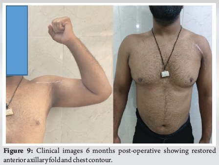 A Wrestler’s Nightmare: Pectoralis Major Tendon Tear and its Repair-A ...