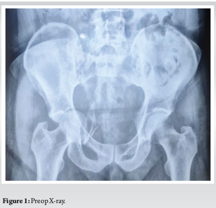 Total Hip Arthroplasty in a Case of Neglected Central Hip Dislocation ...
