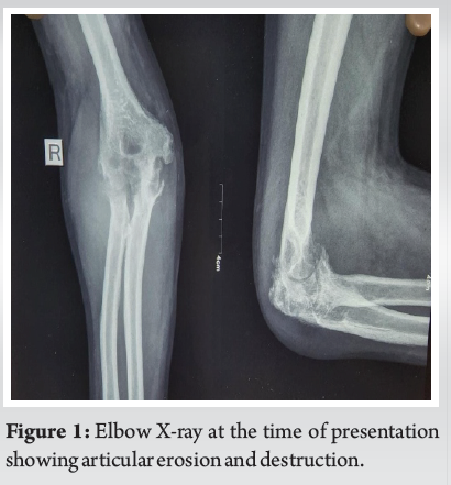 “An Atypical Presentation of Tuberculosis Elbow” – A Case Report ...