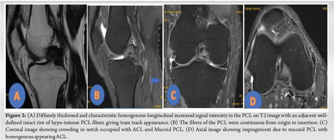 Mucoid Degeneration of Posterior Cruciate Ligament – A Case Study ...