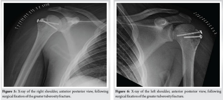 Bilateral Anterior Shoulder Dislocations with Greater Tuberosity ...