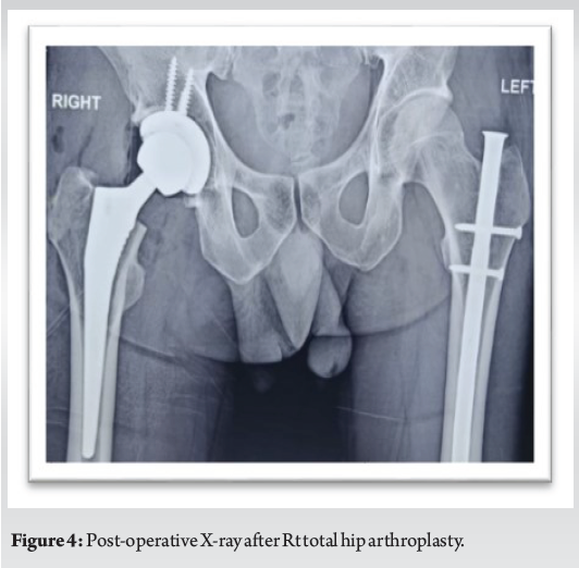 Adult Post-traumatic Recurrent Posterior Hip Dislocation with 17-year ...