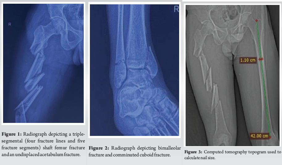 Triple-Segmental Shaft Femur Fracture: A Case Report | Journal of ...