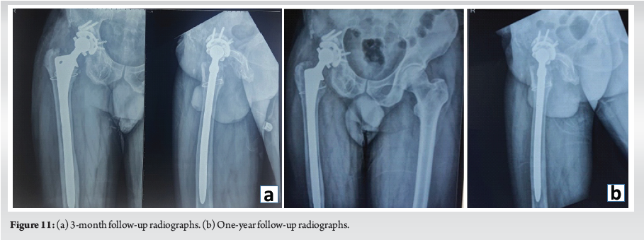 Re-revision Following Failed Revision Total Hip Arthroplasty in a Case ...