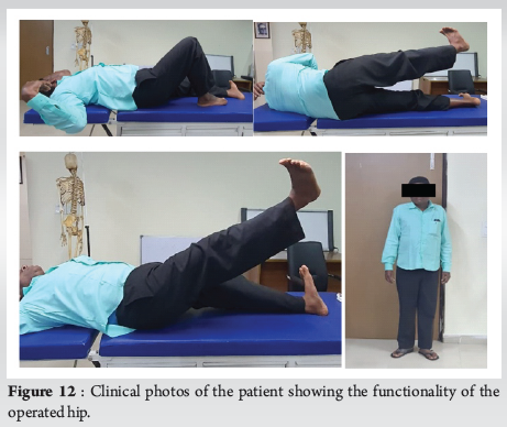 Re-revision Following Failed Revision Total Hip Arthroplasty in a Case ...