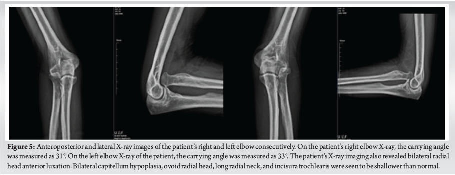 A Rare Case of Bilateral Congenital Radial Head Dislocation: A Case ...