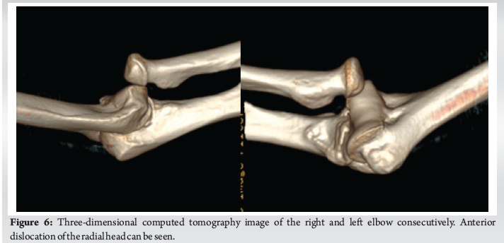 A Rare Case of Bilateral Congenital Radial Head Dislocation: A Case ...