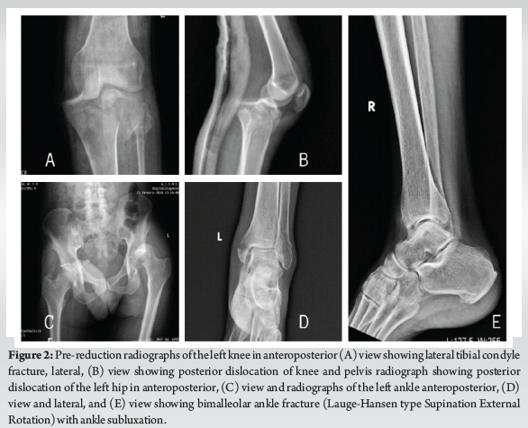 Triple Traumatic Fracture-Dislocation: A Rare Case of Simultaneous ...