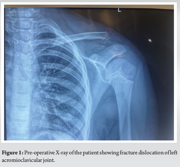 Pediatric AC Joint Fracture Dislocation: Arthroscopy-assisted Reduction ...