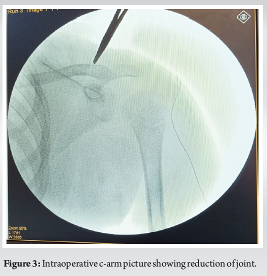 Pediatric AC Joint Fracture Dislocation: Arthroscopy-assisted Reduction ...