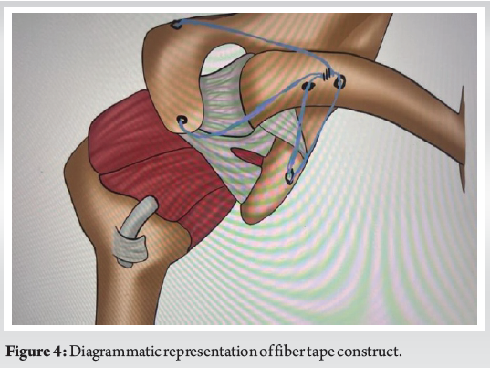 Pediatric AC Joint Fracture Dislocation: Arthroscopy-assisted Reduction ...