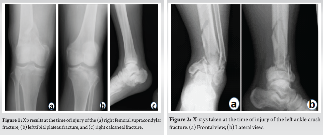 Treatment and Rehabilitation of Complicated Fractures of Both Lower ...