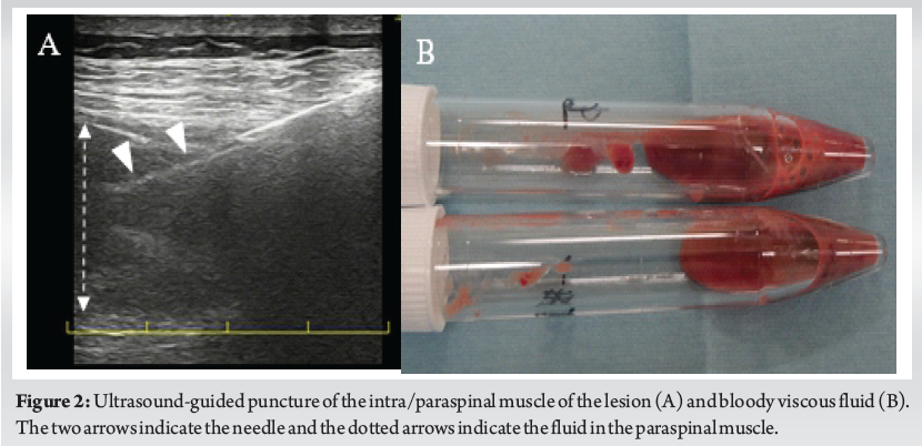 A Rare Case of the Ipsilateral Paraspinal Muscle Abscess Communicating ...