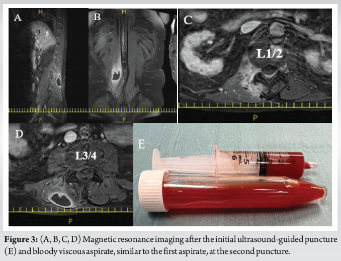 A Rare Case of the Ipsilateral Paraspinal Muscle Abscess Communicating ...
