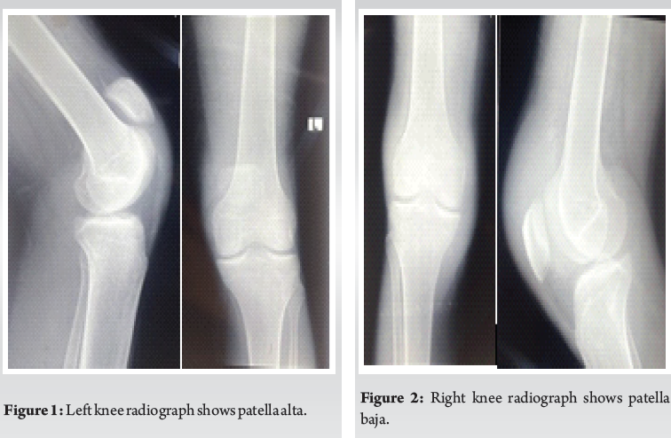 Simultaneous Bilateral Knee Extensor Mechanism Injury in a Young Male ...