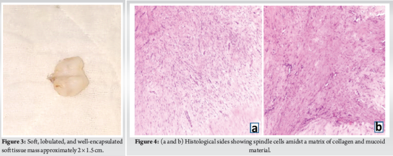 Benign Spindle Cell Tumor of Flexor Tendon Sheath of Toe: A Rare Case ...