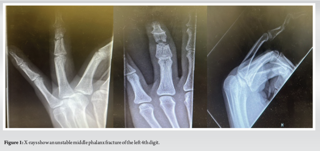 Double X Configuration Screw Fixation for Middle Phalanx Fracture – A ...