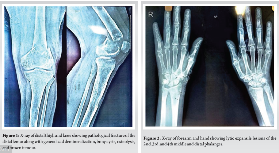 A Primary Hyperparathyroidism in an Adolescent Female with Pathological ...