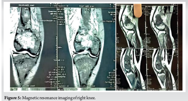 A Primary Hyperparathyroidism in an Adolescent Female with Pathological ...