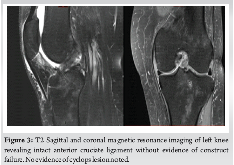 Inverted Cyclops Lesion Following Anterior Cruciate Ligament Repair: A ...