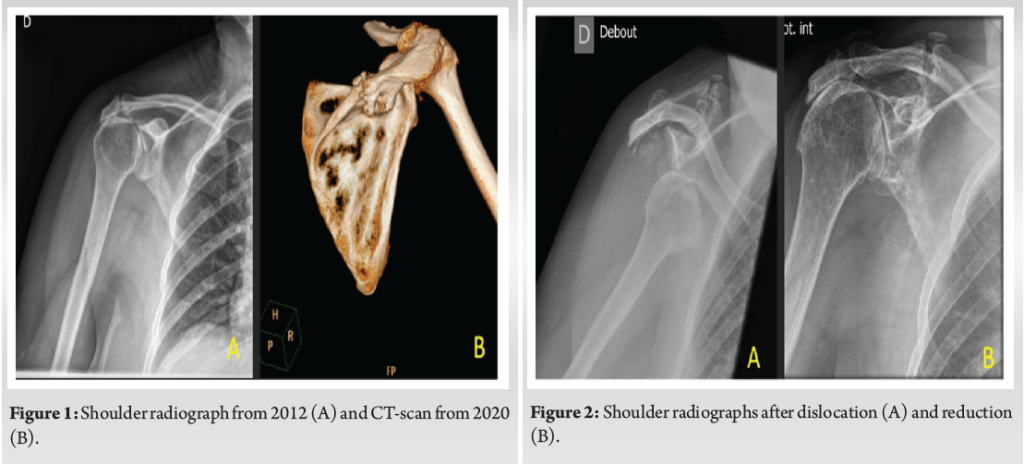 Cuff Arthropathy, Scapular Spine Fracture Non-union, and Instability ...