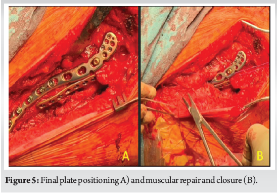 Cuff Arthropathy, Scapular Spine Fracture Non-union, and Instability ...