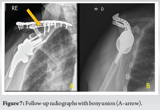 Cuff Arthropathy, Scapular Spine Fracture Non-union, and Instability ...