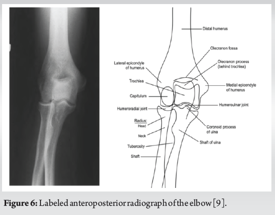 A Case of “Subtle” Missed Complex Elbow Dislocation – Learning from ...