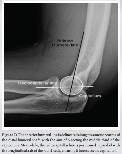 A Case of “Subtle” Missed Complex Elbow Dislocation – Learning from ...