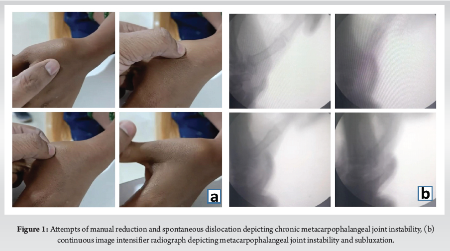 Flexor Carpi Radialis Tendon Stabilization for Chronic First ...