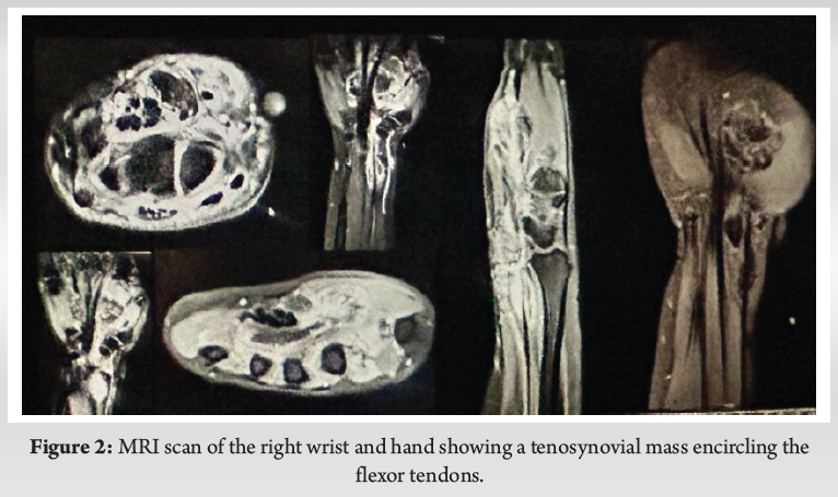 A Rare Case of Localized Pigmented Villonodular Synovitis of the Wrist ...
