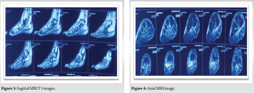 Angiolipoma of Cuboid Bone: A Rare Case Report | Journal of Orthopaedic ...