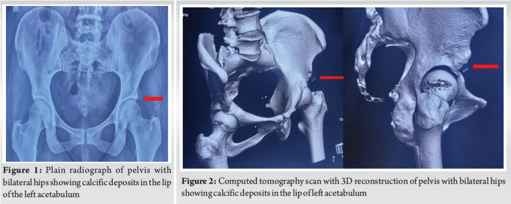 Uncommon Presentation of Hip Pain Due to Calcific Tendonitis in the ...