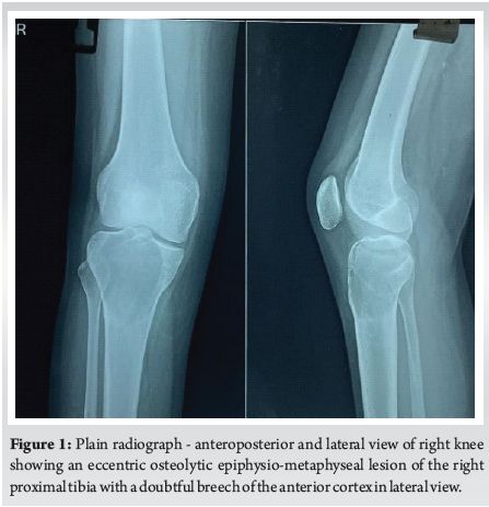 A Rare Case Report of Advanced Surgical Management of Proximal Tibia ...